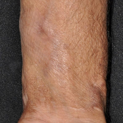 Burn Scars Removal – Simply Better Skin